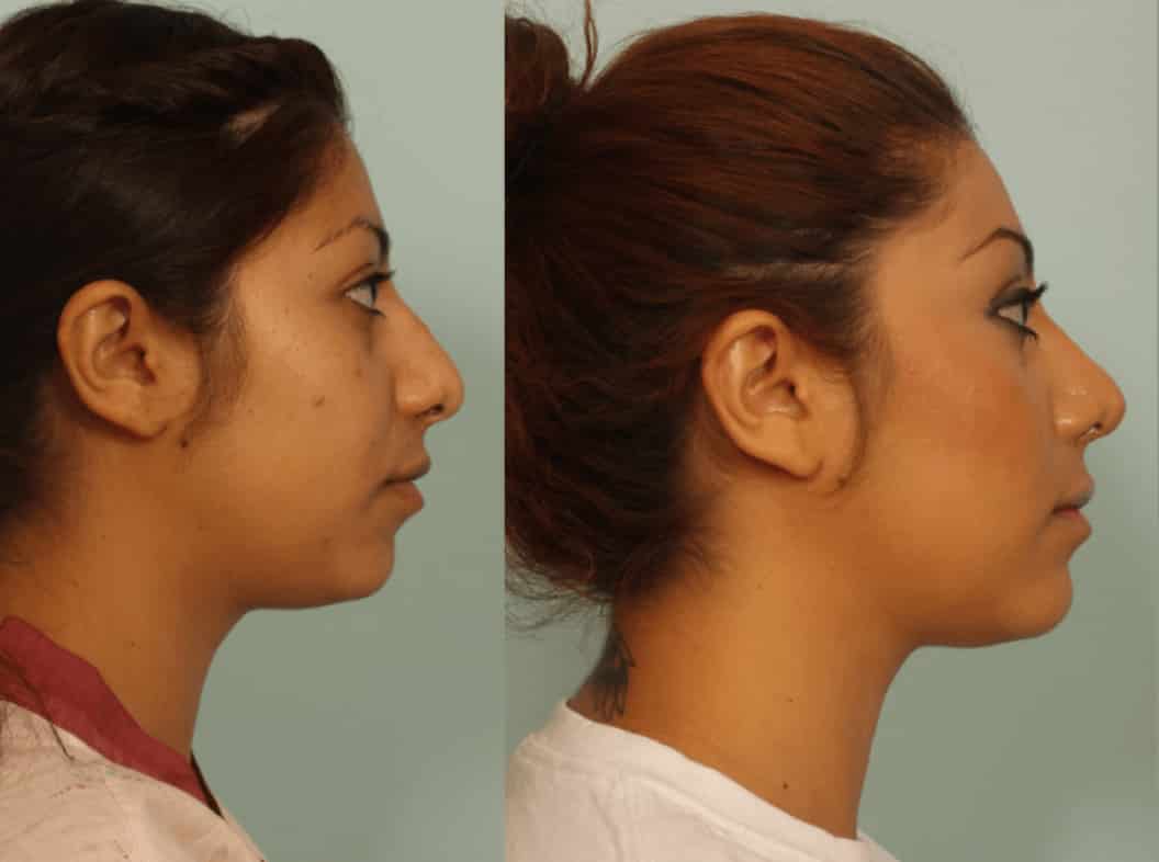 How a Chin Augmentation Can Change the Entire Facial Profile