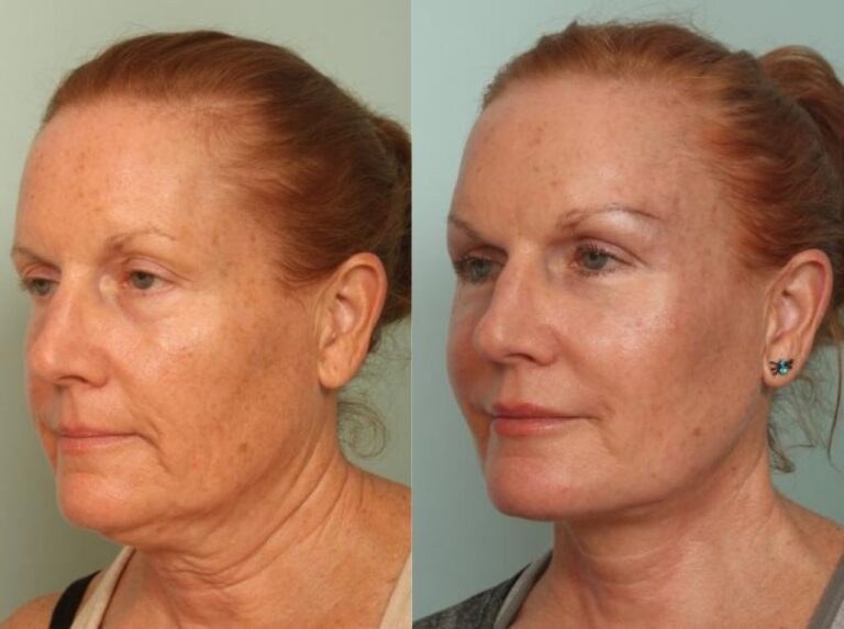 Glidelift™ El Paso | Deep-Plane Facelift El Paso Cosmetic Surgery