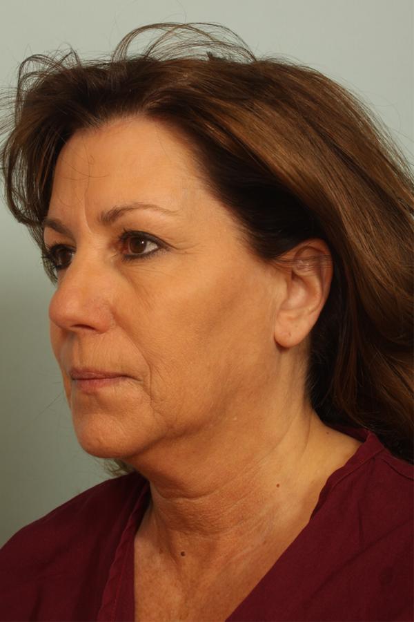Facelift - El Paso Cosmetic Surgery