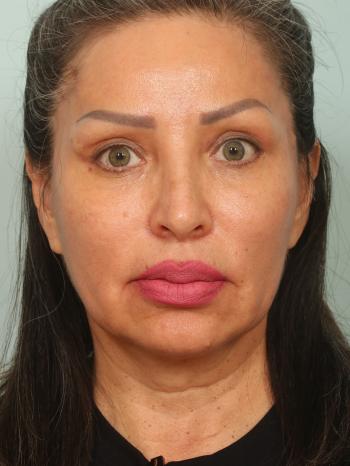 Brow Lift - El Paso Cosmetic Surgery